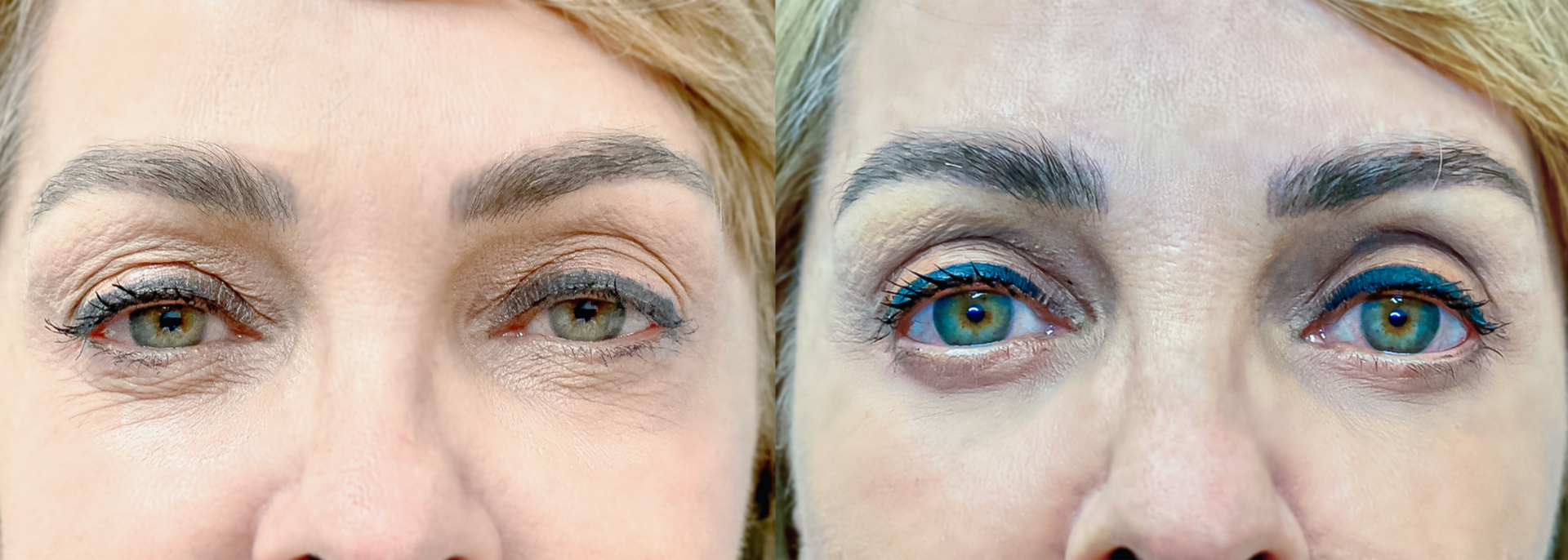 Eyelid Surgery in Miami | Imagos Plastic Surgery